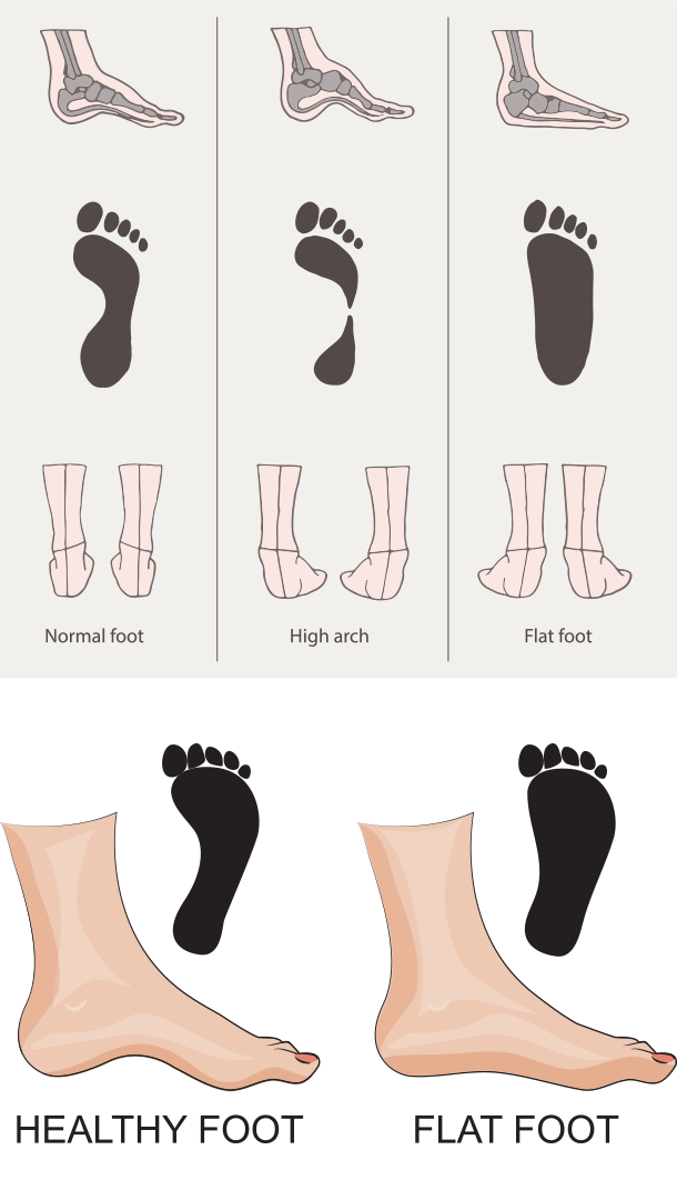 Platfus - Simptome și tratament 100% pentru picior plat